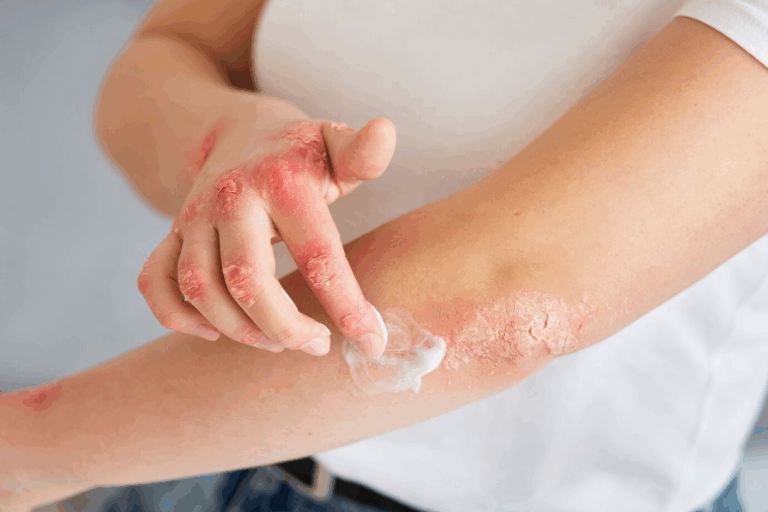 Dermatitis seborreica: Guía completa para identificarla y combatirla eficazmente